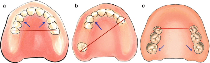 Direct and Indirect Retainers | SpringerLink