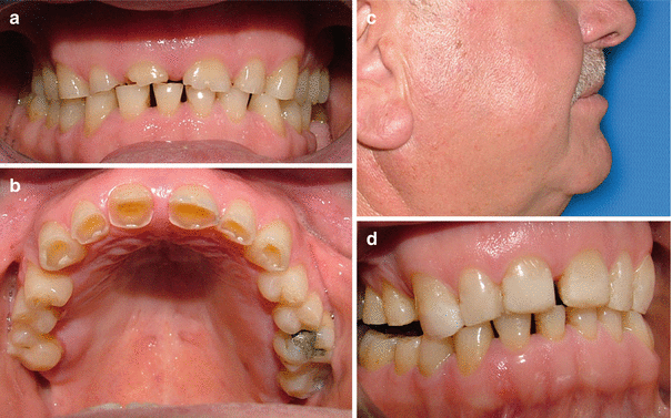 Re-establishing Occlusal Vertical Dimension and Maximal Intercuspal ...