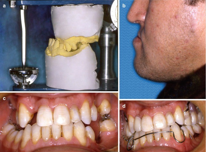 Re-establishing Occlusal Vertical Dimension and Maximal Intercuspal ...