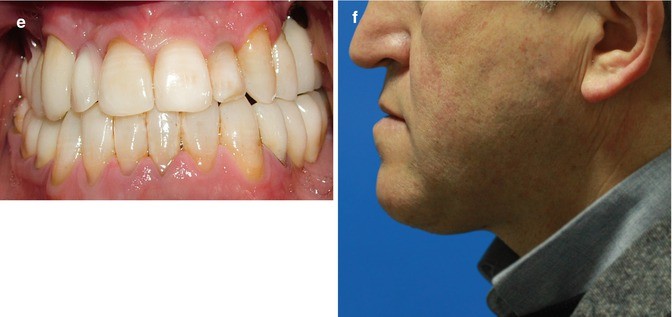 Re-establishing Occlusal Vertical Dimension and Maximal Intercuspal ...