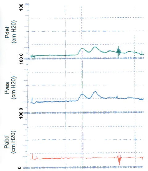The Cystometrogram | SpringerLink