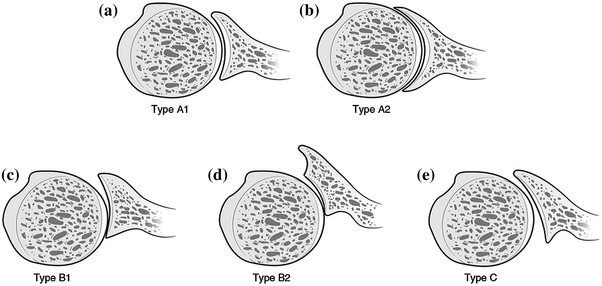 RSA with Glenoid Bone Loss | SpringerLink