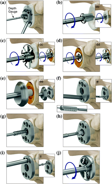 Arthrex® Univers Revers™ Shoulder Prosthesis | SpringerLink