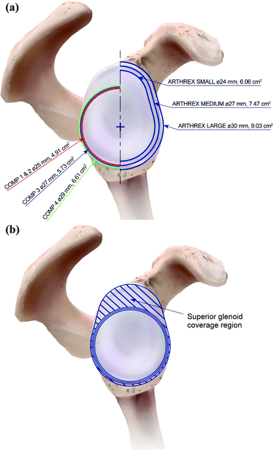 Arthrex® Univers Revers™ Shoulder Prosthesis | SpringerLink