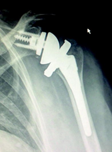 The Biomet Comprehensive© Reverse Total Shoulder System Design ...