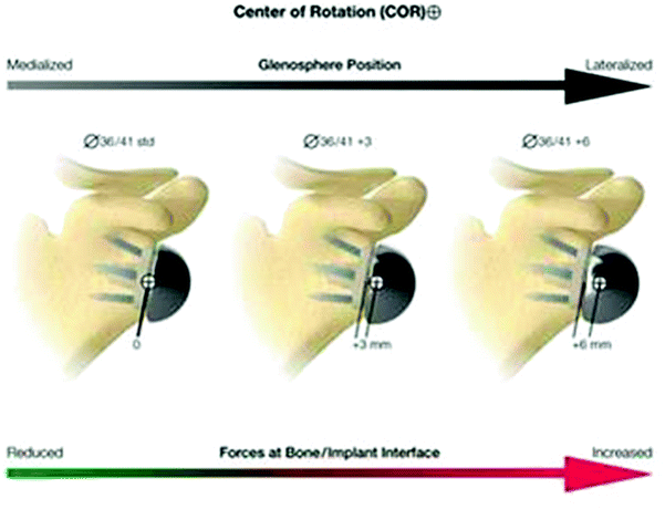 The Biomet Comprehensive© Reverse Total Shoulder System Design ...