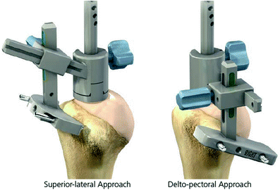 Depuy Synthes DELTA XTEND™ | SpringerLink
