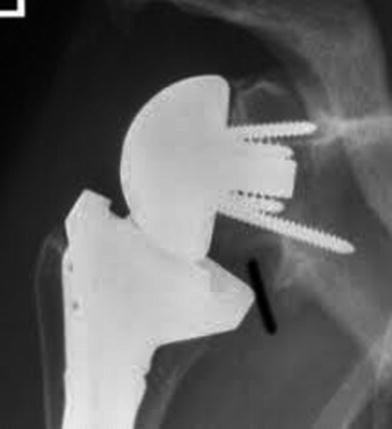 DJO Surgical Reverse Shoulder Prosthesis (RSP™) | SpringerLink