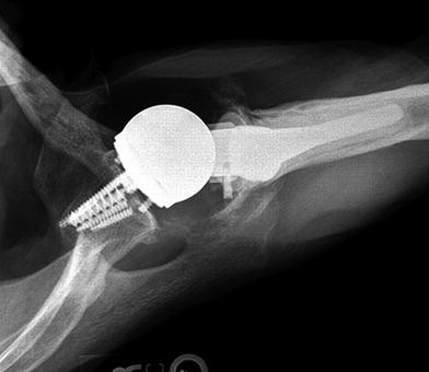 DJO Surgical Reverse Shoulder Prosthesis (RSP™) | SpringerLink