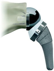 Tornier Aequalis Ascend™ Flex Convertible Shoulder System | SpringerLink