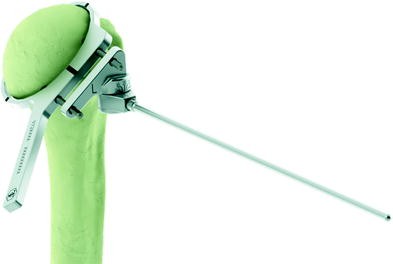 Tornier Aequalis Ascend™ Flex Convertible Shoulder System | SpringerLink