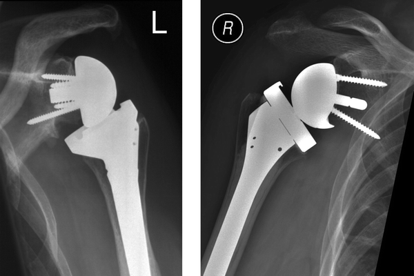 Motion and Muscular Function After Reverse Shoulder Arthroplasty ...