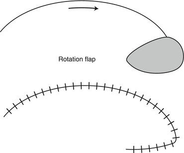Rotation Flaps of the Scalp: Study of the Design, Planning and ...