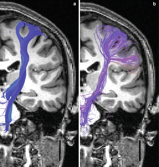 Merits and Limits of Tractography Techniques for the Uninitiated ...