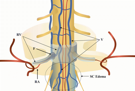 Spinal Dural Arteriovenous Fistula: A Review | SpringerLink