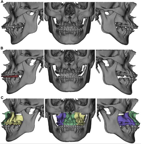 Concomitant TMJ Total Joint Replacement and Orthognathic Surgery ...