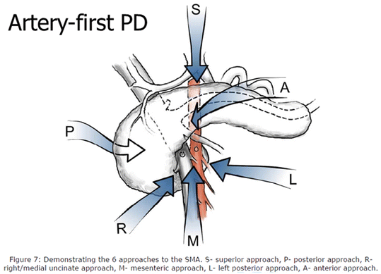 Artery-First Approaches to Pancreaticoduodenectomy | SpringerLink