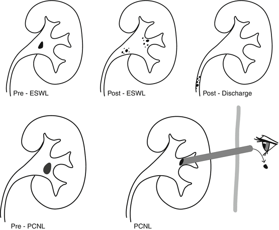 Indications for PCNL | SpringerLink