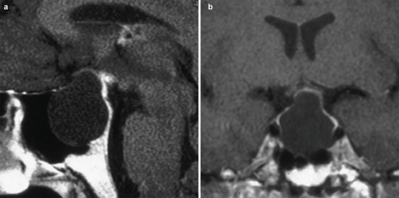 Sellar Region Arachnoid Cysts | SpringerLink