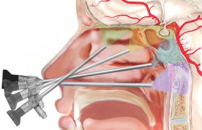 The Direct Endoscopic Endonasal Transsphenoidal Approach to the Pituitary Gland | SpringerLink