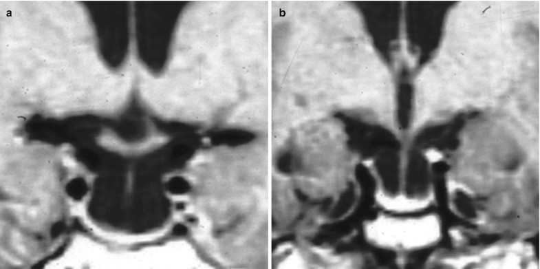 Empty Sella Syndrome | SpringerLink