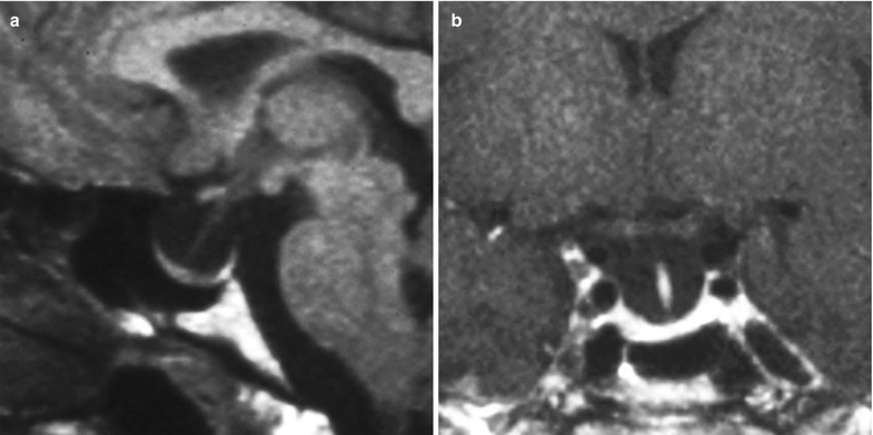Empty Sella Syndrome | SpringerLink