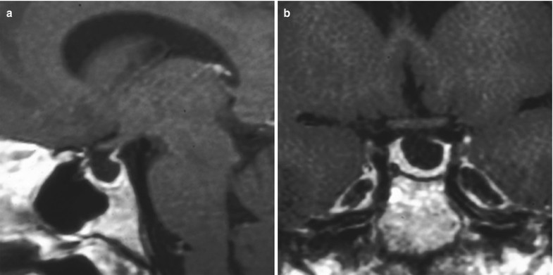 Empty Sella Syndrome | SpringerLink
