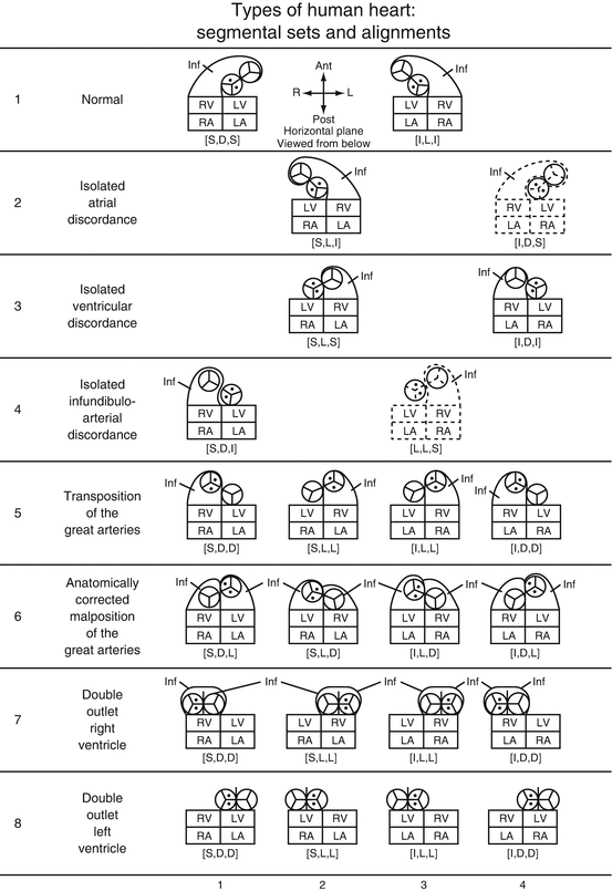 Definition of Conotruncal Anomalies | SpringerLink