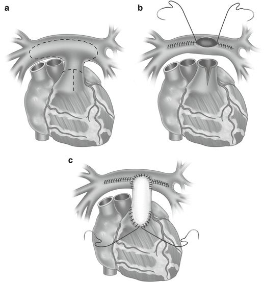 Tetralogy of Fallot with Absent Pulmonary Valve Syndrome | SpringerLink