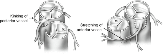 Arterial Switch in TGA-IVS: Coronary Transfer | SpringerLink