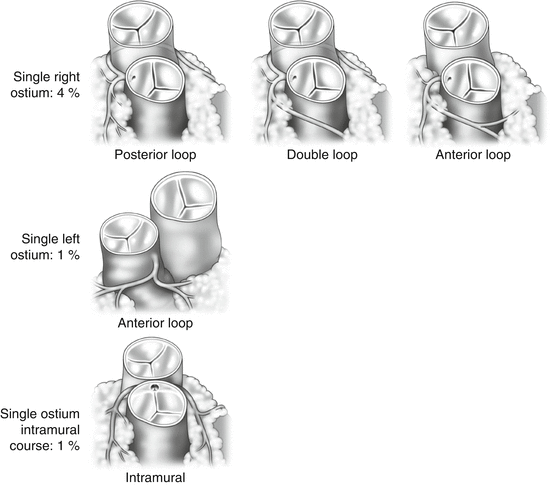 Arterial Switch in TGA-IVS: Coronary Transfer | SpringerLink