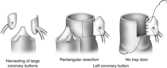 Arterial Switch in TGA-IVS: Coronary Transfer | SpringerLink