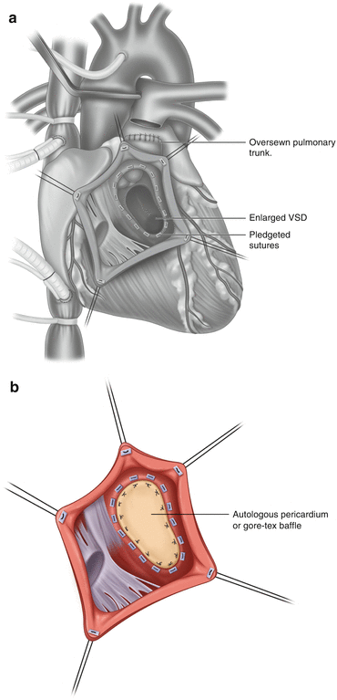 TGA-VSD and LVOTO: Rastelli Procedure | SpringerLink
