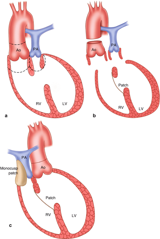 Double Root Translocation Operation for Complete Transposition of Great ...