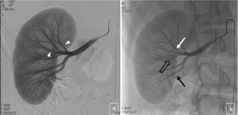 Renal Angiography and Embolization | SpringerLink