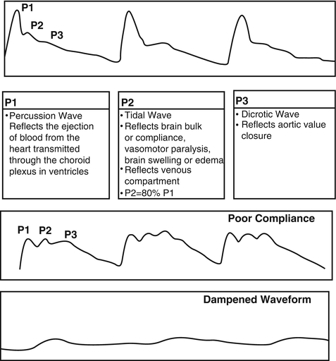 Extraventricular Drains and Ventriculostomy | SpringerLink