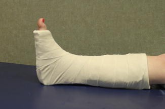 Fracture Immobilization and Splinting | SpringerLink