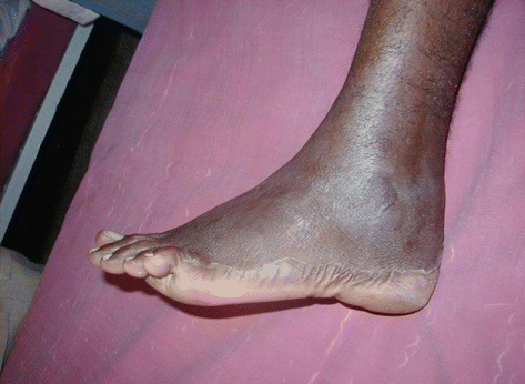 Lymphatic Filariasis (Elephantiasis) | SpringerLink