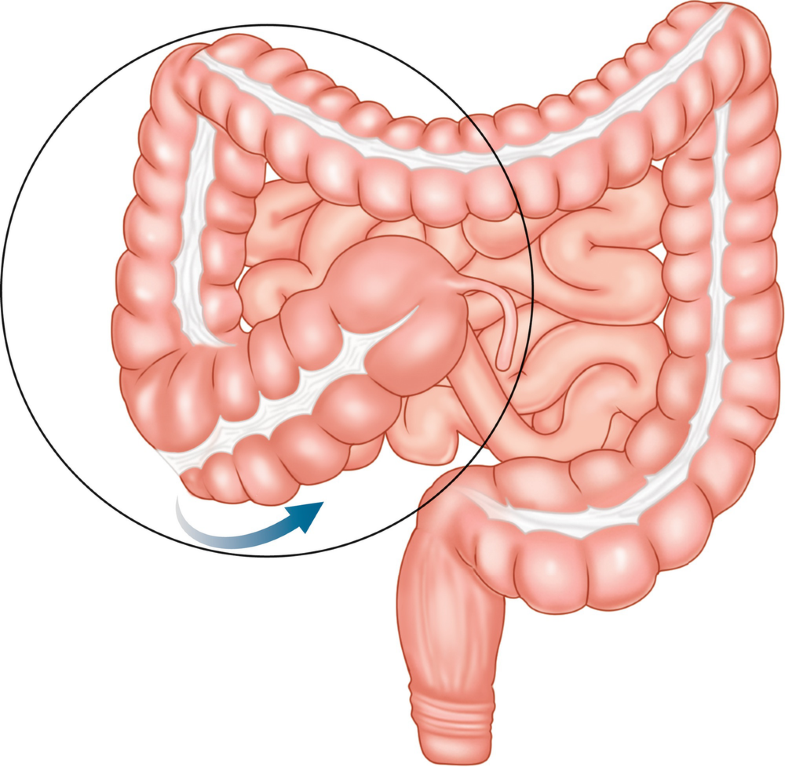 Large Bowel Obstruction | SpringerLink
