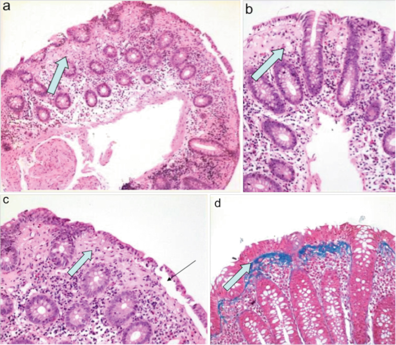 Radiation, Microscopic, Ischemic Colitis | SpringerLink