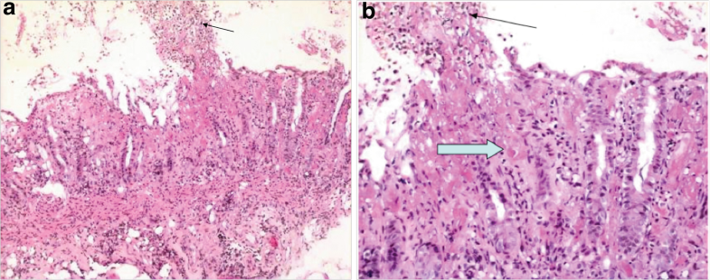 Radiation, Microscopic, Ischemic Colitis | SpringerLink