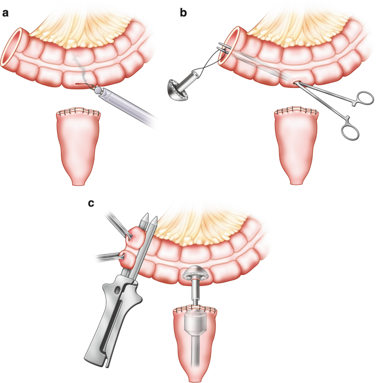 Anastomotic Construction | SpringerLink