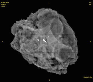Radioguided Surgery for Non-palpable Breast Lesions: I-125 Radioactive ...