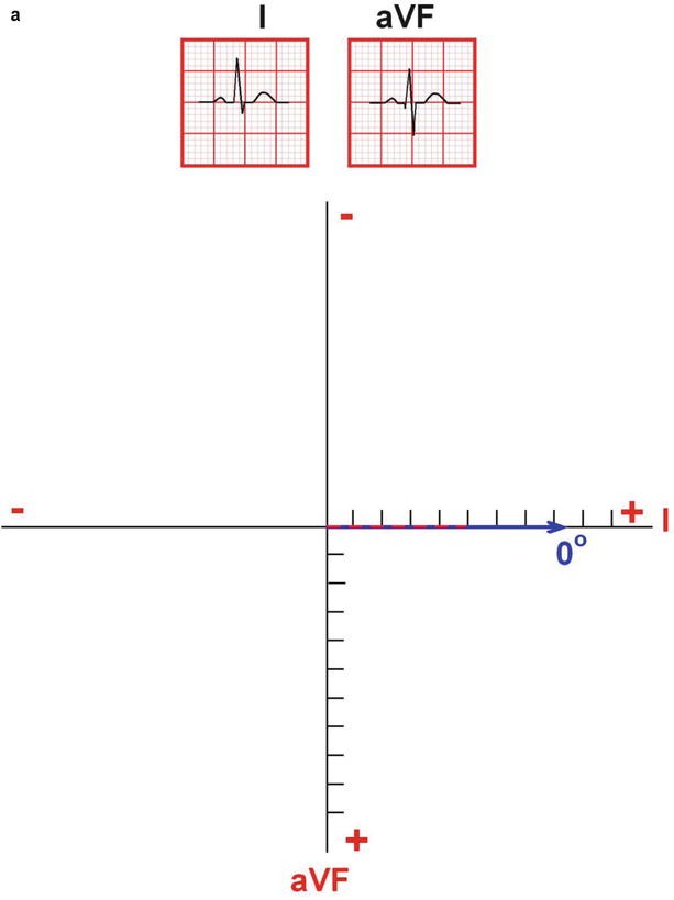 Cardiac Axis: Calculation and Interpretation | SpringerLink
