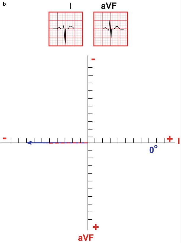 Cardiac Axis: Calculation and Interpretation | SpringerLink