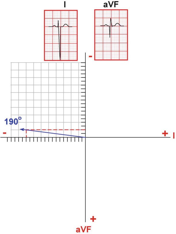 Cardiac Axis: Calculation and Interpretation | SpringerLink