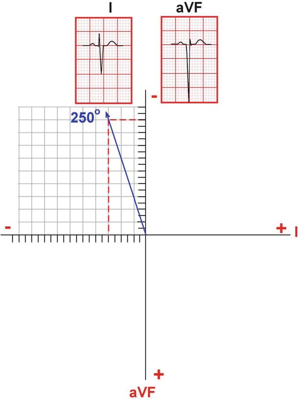 Cardiac Axis: Calculation and Interpretation | SpringerLink