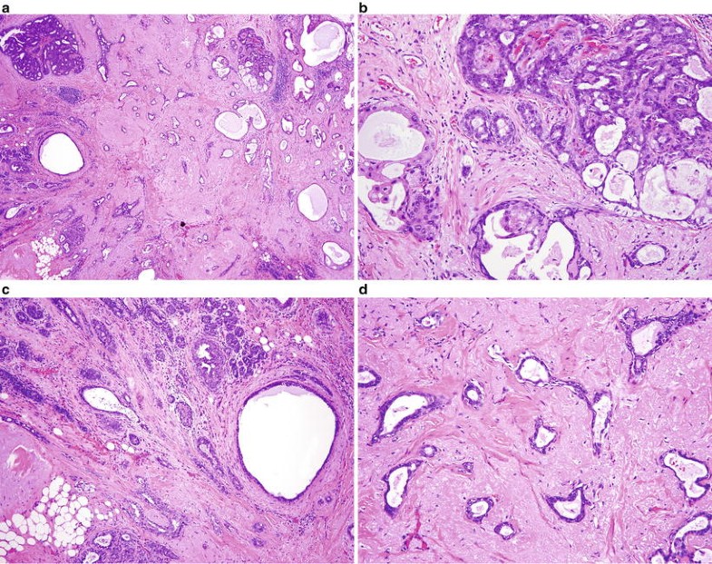 Adenosis, Sclerosing Lesions, Microglandular Adenosis, and Mucocele ...