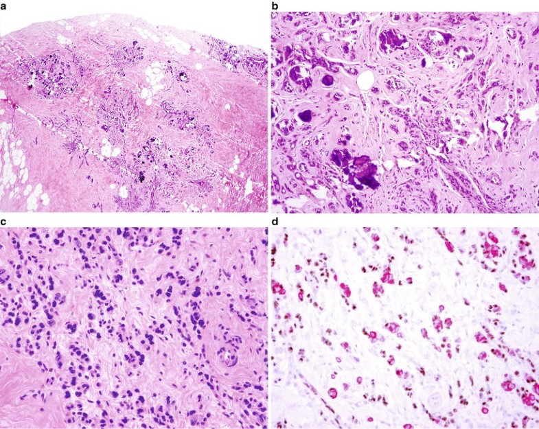 Adenosis, Sclerosing Lesions, Microglandular Adenosis, and Mucocele ...