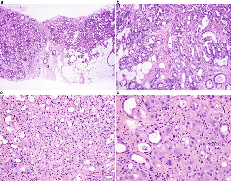 Adenosis, Sclerosing Lesions, Microglandular Adenosis, and Mucocele ...